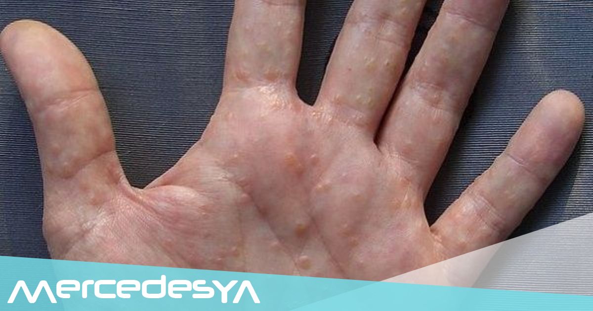 Cómo lidiar con el eccema dishidrótico: consejos y recomendaciones ...